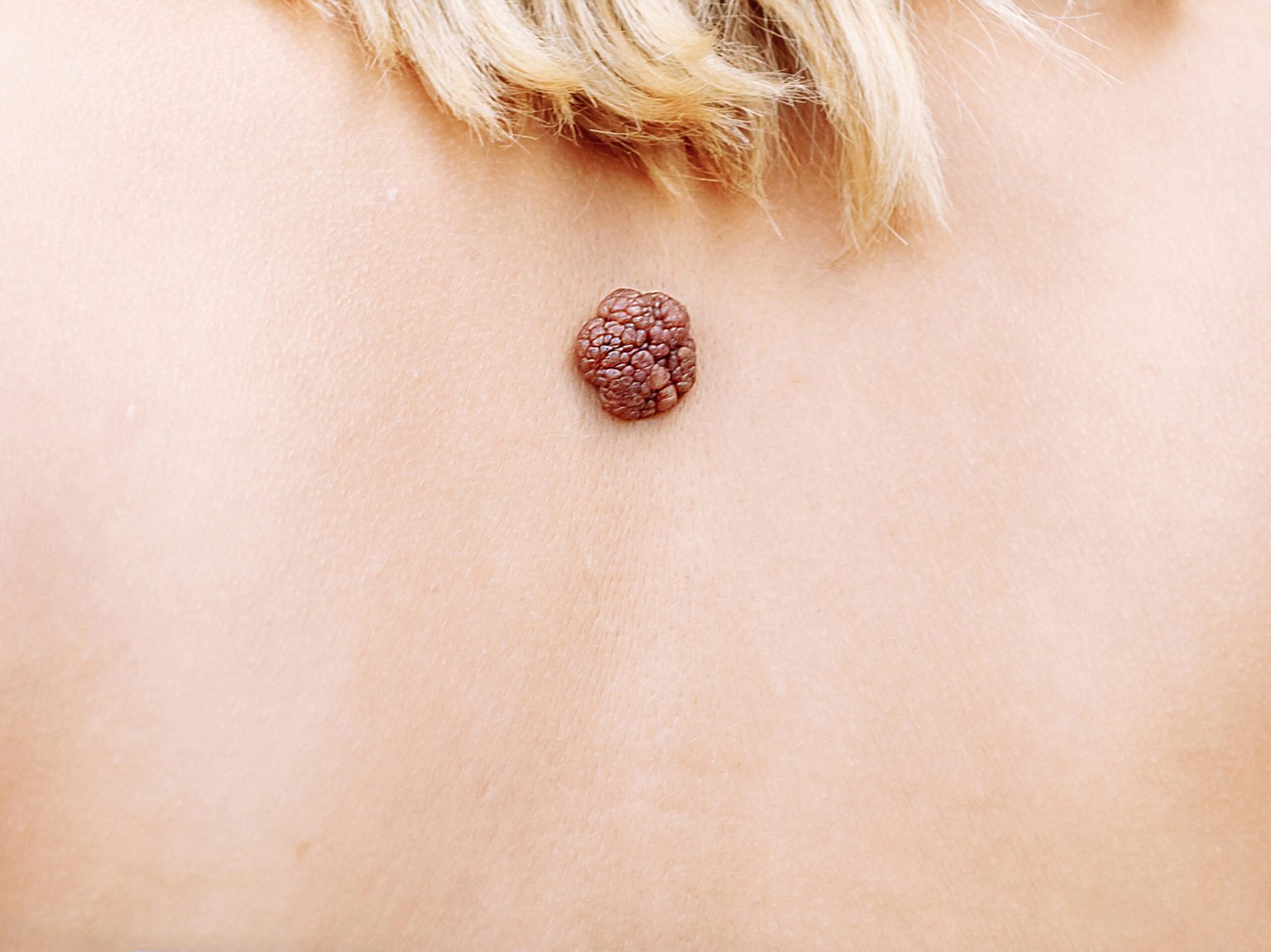 Moles 101: Your Comprehensive Guide to Removing Them - Radiance Skin ...